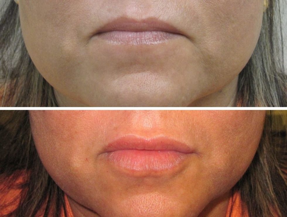 Lip Injections - Physician's Ageless Solutions - Laser Hair Removal ...